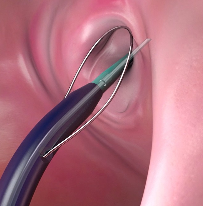Transseptal Solutions - Advanced steerable transseptal puncturing system