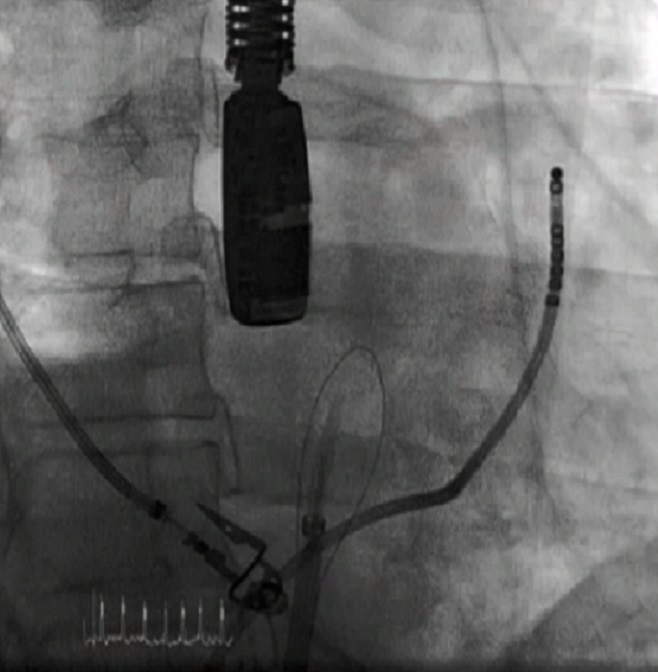 Transseptal Solutions - Advanced steerable transseptal puncturing system
